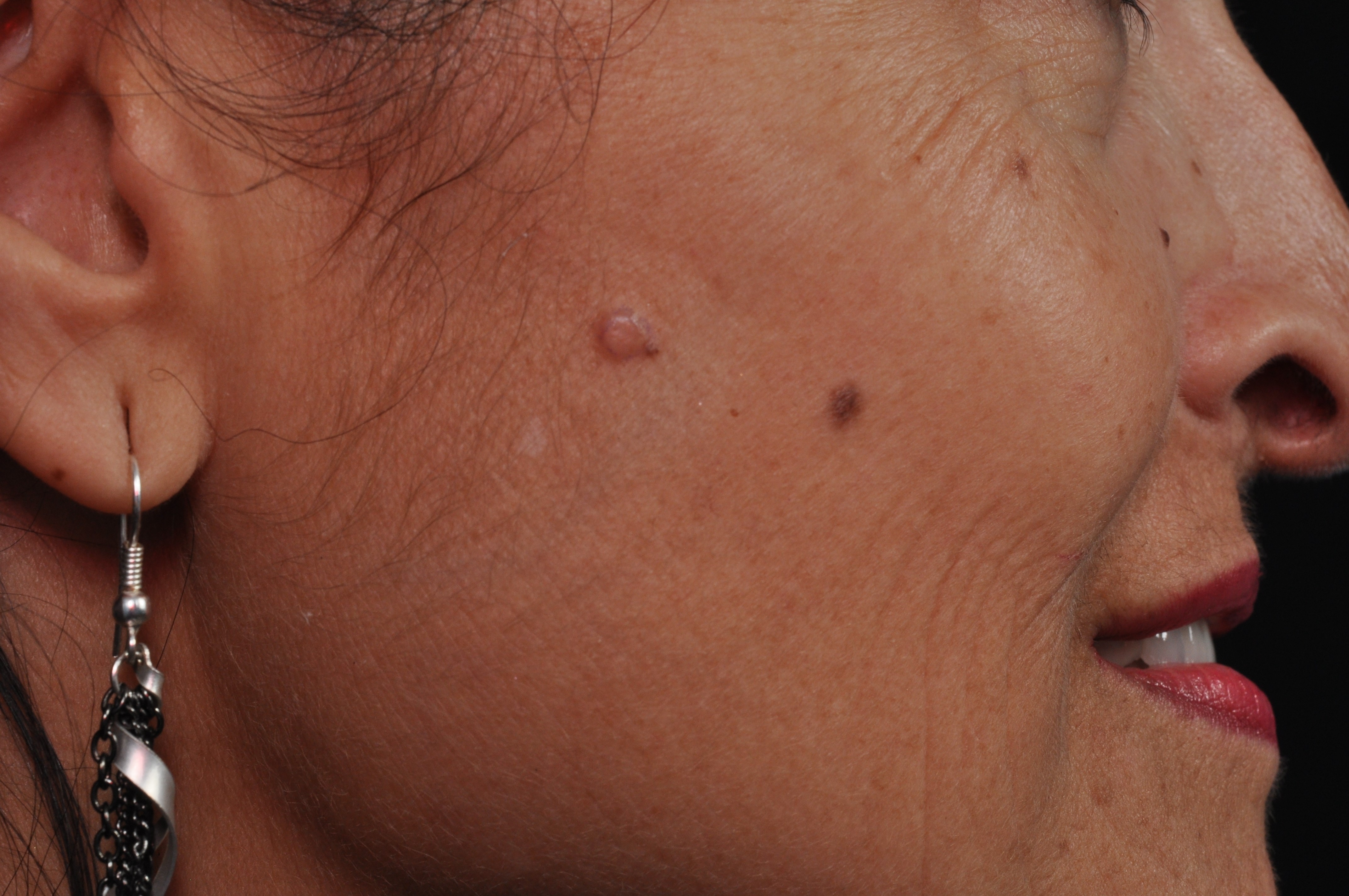 Skin Cancer Photo Gallery Skin Cancer Photo Gallery