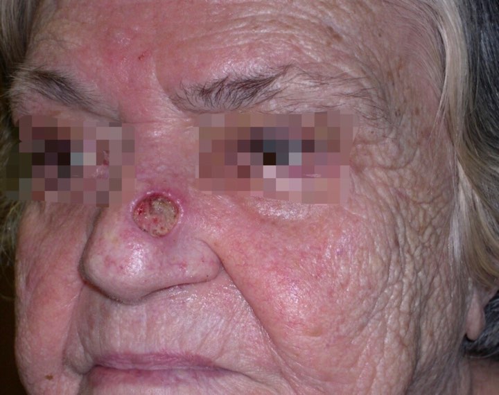 Skin Cancer Photo Gallery